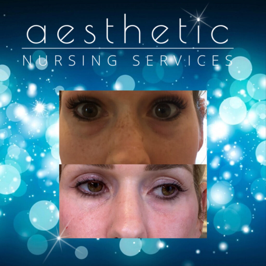 All About Tear Trough Filler - Aesthetic Nursing Services